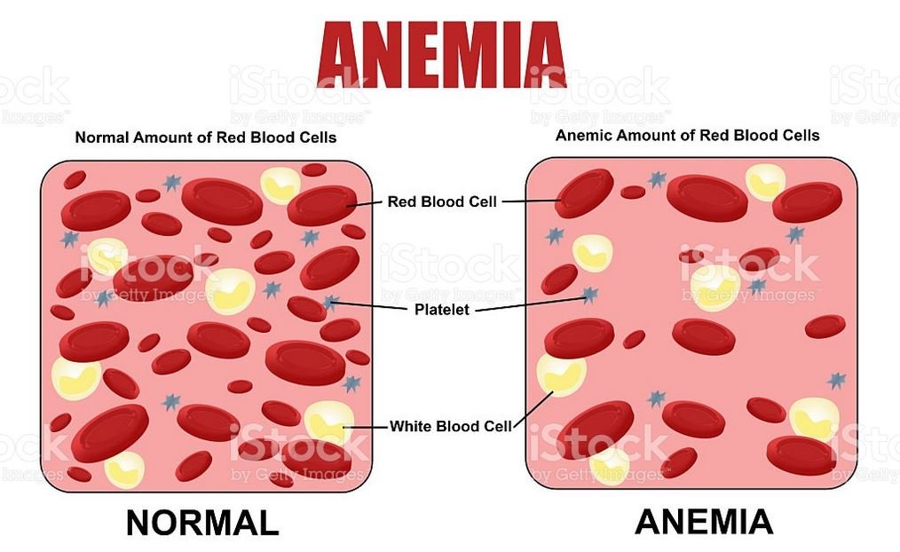 Anemia - Simptomat dhe Shkaqet - Sherohu.com